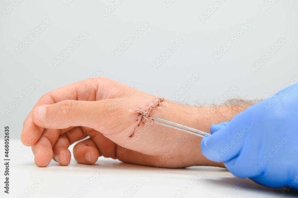 wound hand, suturing the wound. The type of cut after surgery. Stock ...