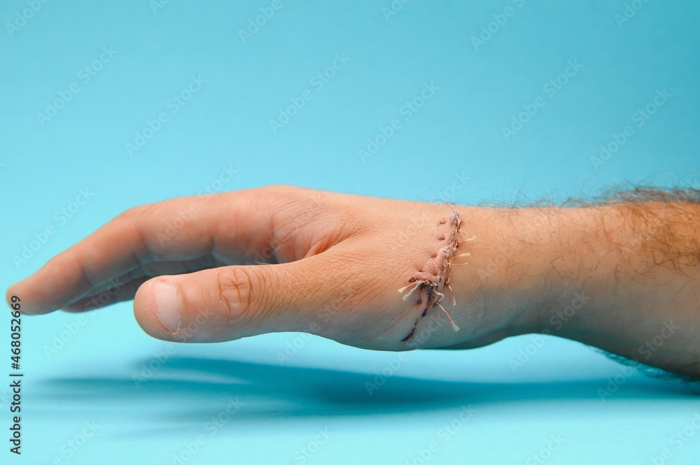 Suture wound on hand,Pain of accident concept Stock Photo | Adobe Stock Suture wound on hand,Pain of accident concept Stock Photo | Adobe Stock