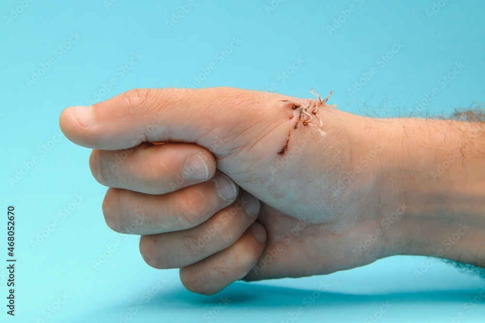 Suture wound on hand,Pain of accident concept Stock Photo | Adobe Stock