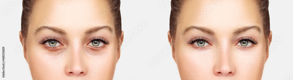 Lower and upper Blepharoplasty.Marking the face.Perforation lines on ...