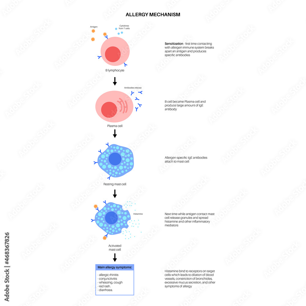 Allergy mechanism diagram Stock Vector | Adobe Stock