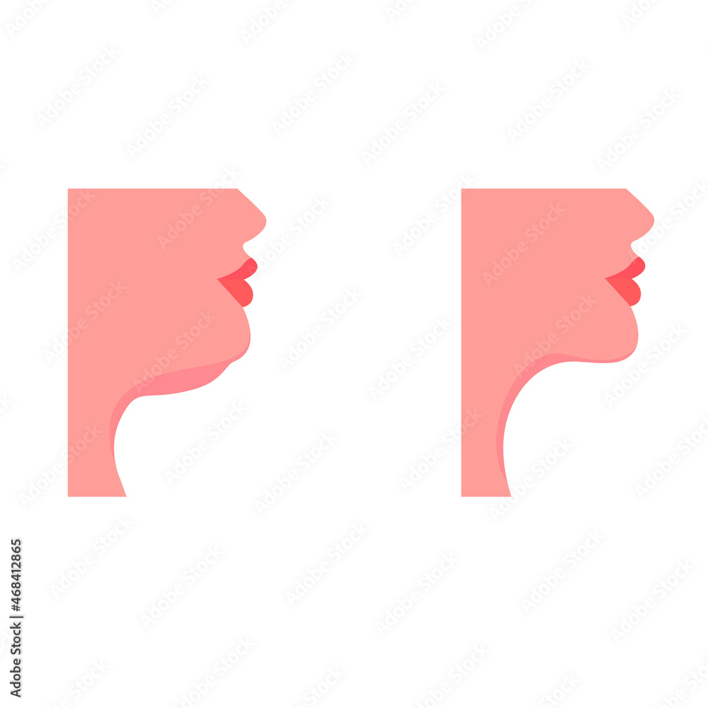 Female profile with and without a double chin. Before and after ...
