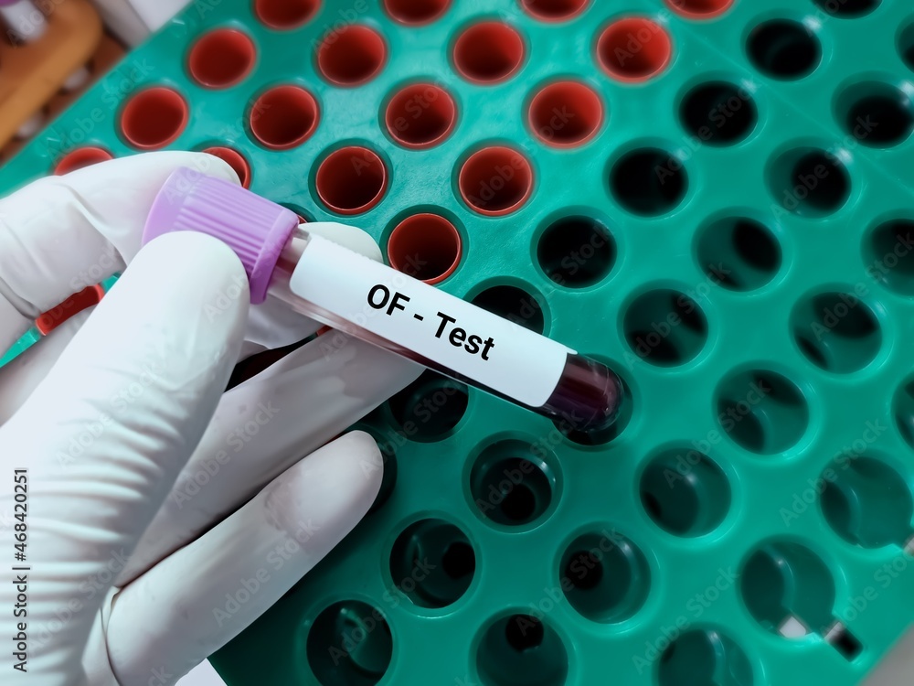 Biochemist or doctor holds blood sample for OF (Osmotic Fragility) test ...