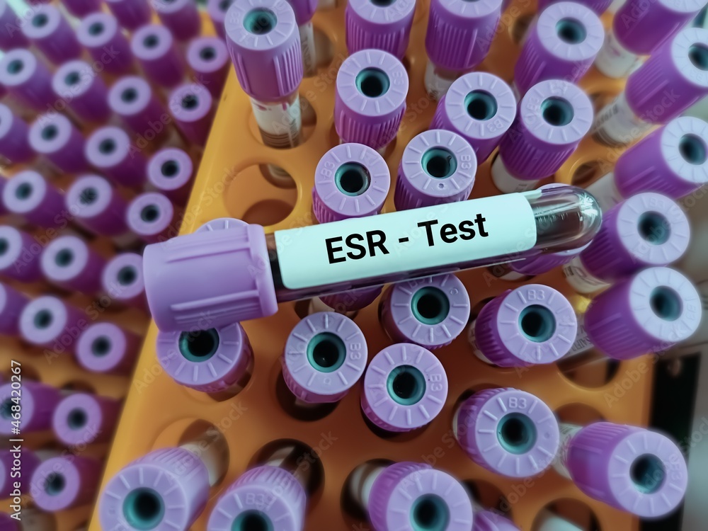 Blood sample for erythrocyte sedimentation rate (ESR) test. Medical ...