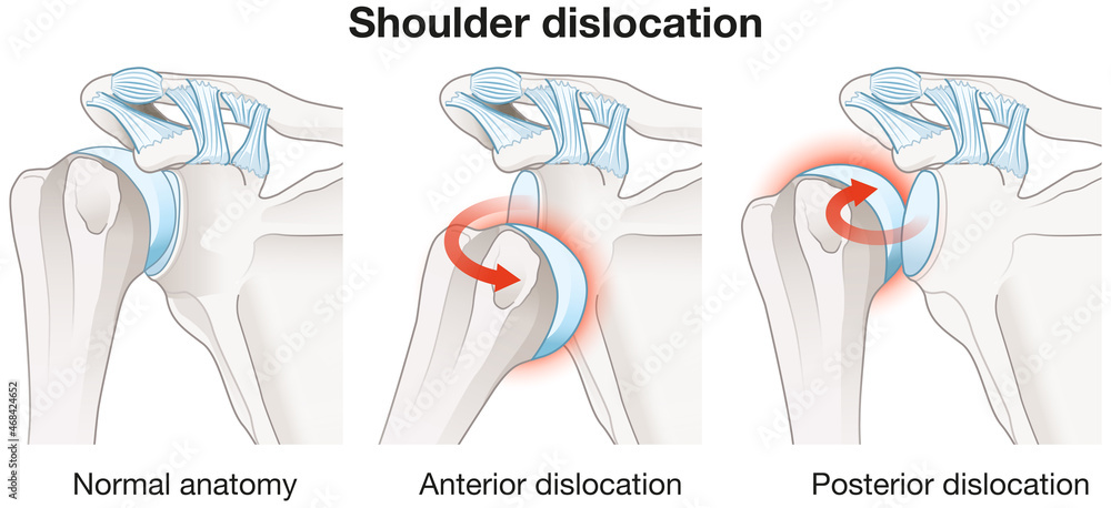 Shoulder dislocation. Anterior dislocation. Posterior dislocation ...