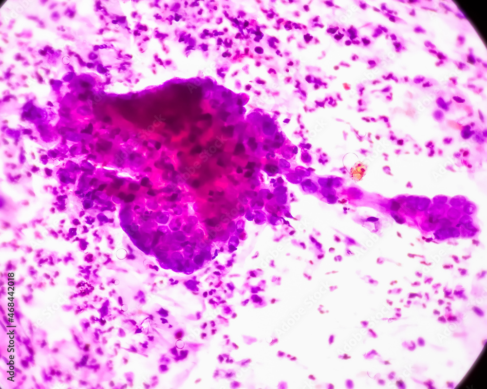 Foto de Cervical cancer cells. Atypical glandular cells fo undetermined ...