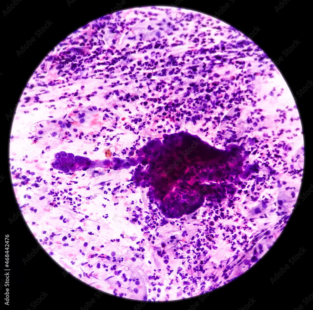 Cervical cancer cells. Atypical glandular cells fo undetermined ...
