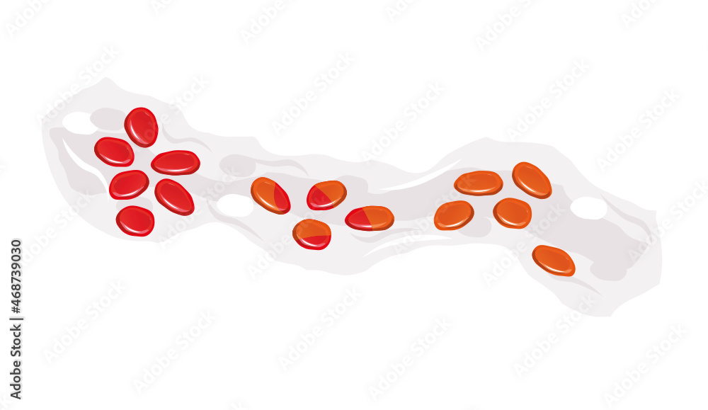 Red blood cells transformed due to high uric acid level Cause disease ...