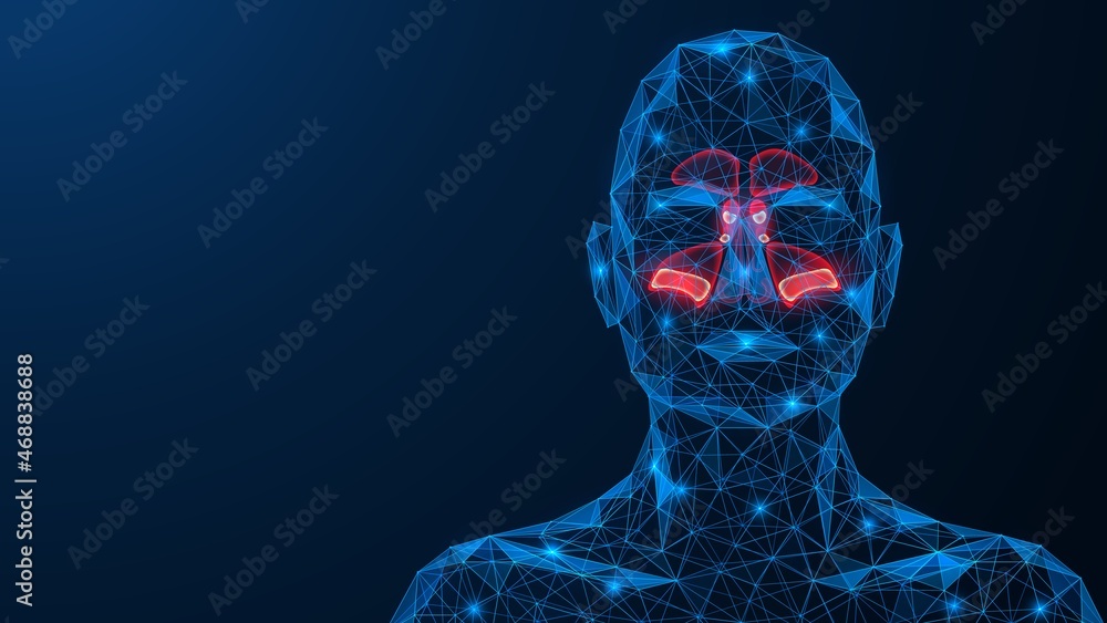 Sinusitis. Purulent inflammation of the para nasal sinuses. A low-poly ...