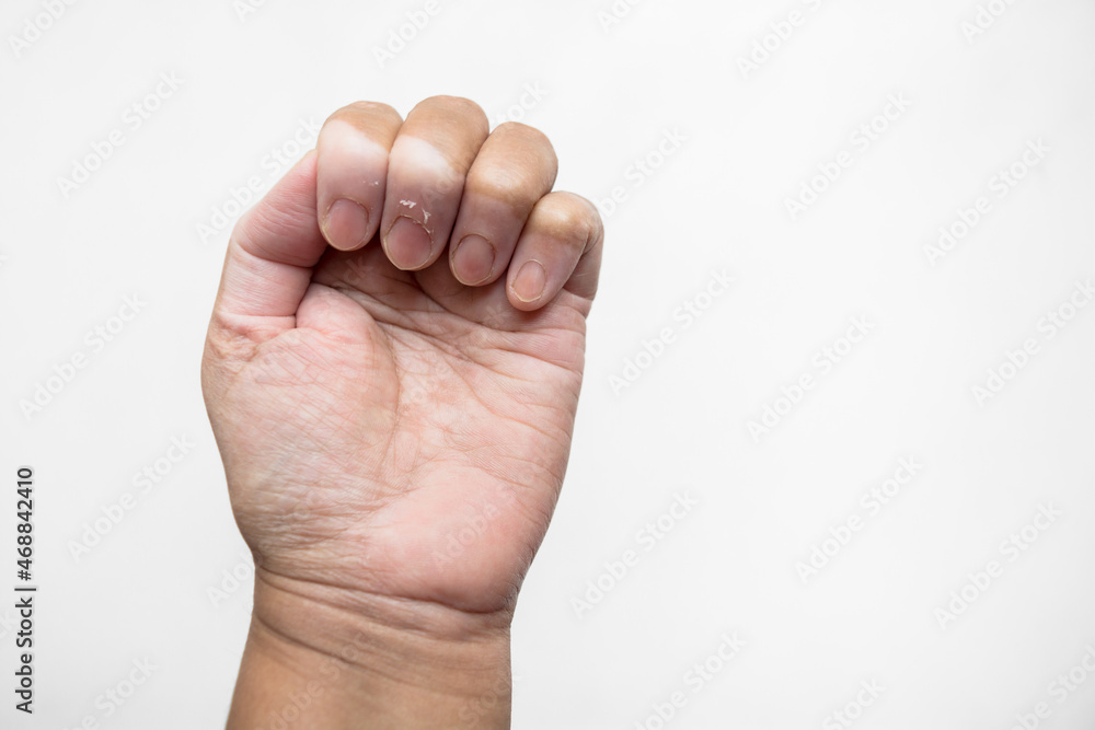 White patches on the palm and fingers, a medical condition showing skin ...