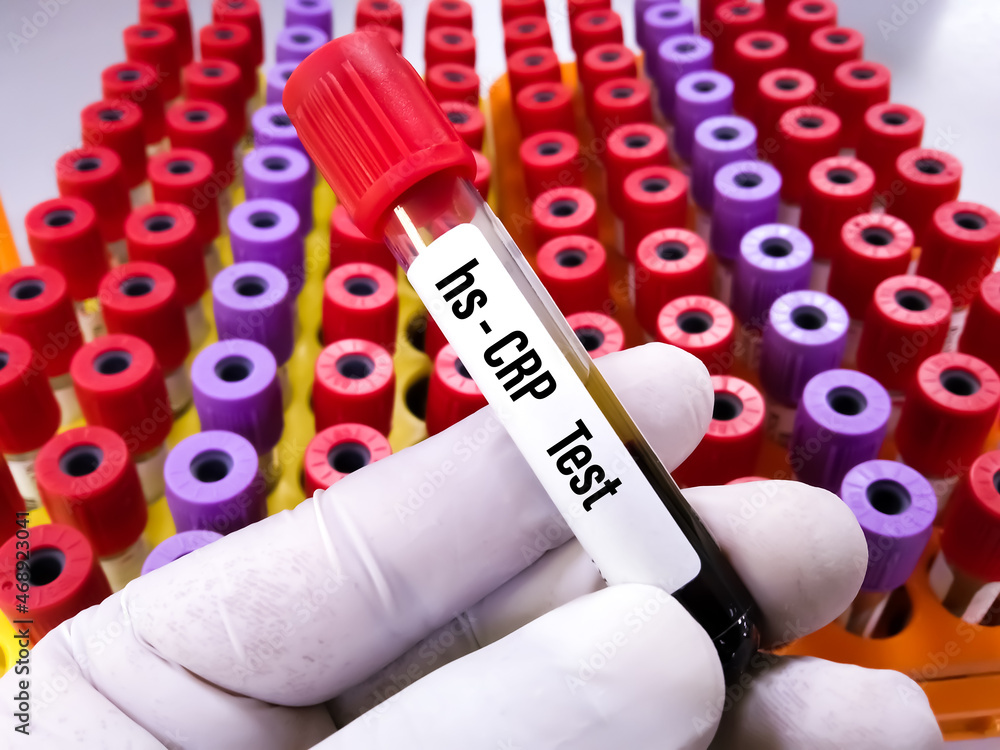Blood sample tube for C-reactive protein (CRP) test and hs-CRP (hs=high ...