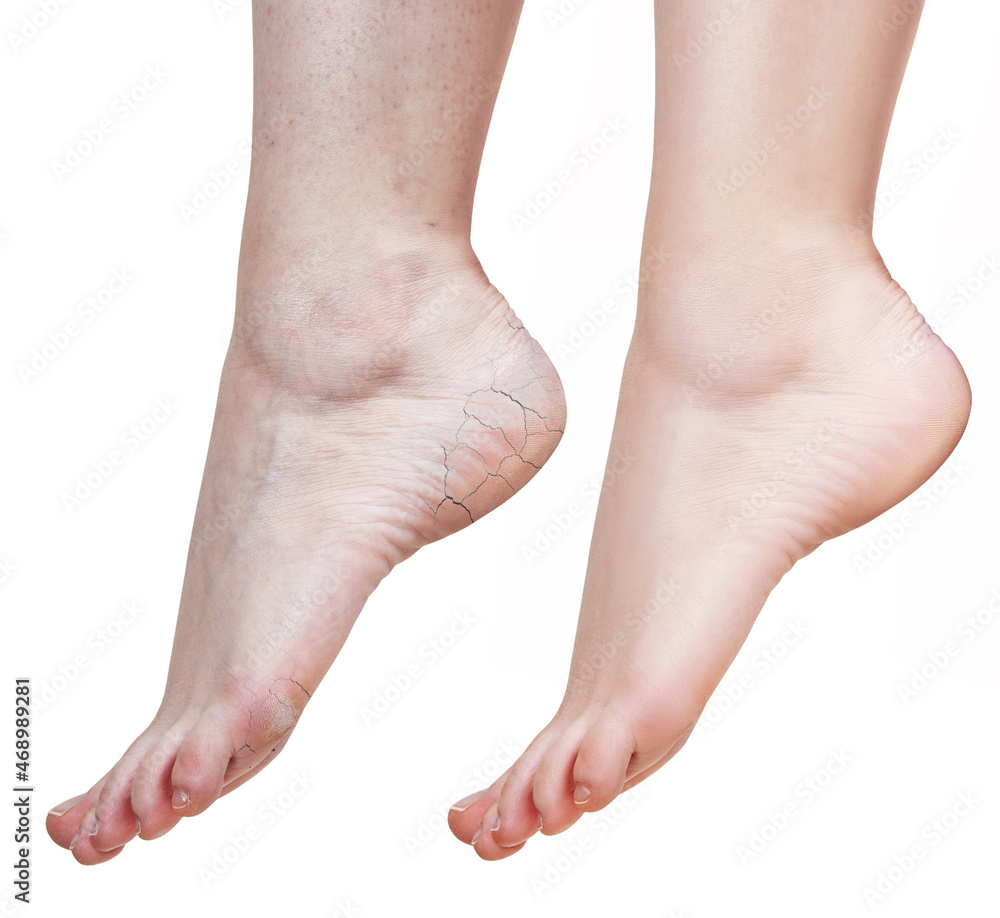 Female feet with dry skin before and after treatment or retouch. Stock ...