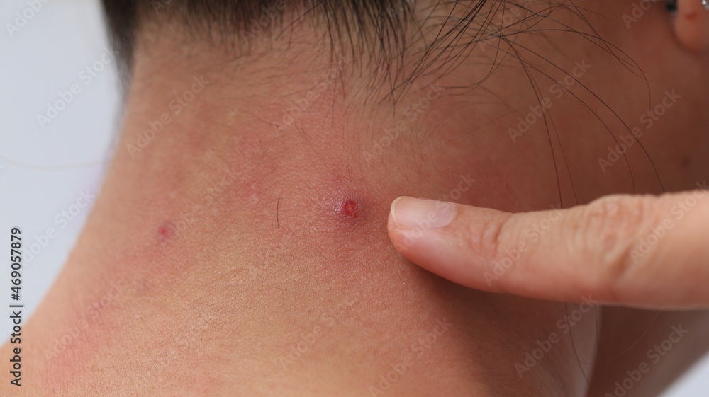 Back Of Neck Acne