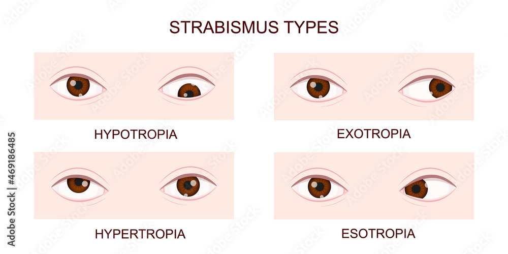 Strabismus types. Hypotropia, hypertropia, exotropia, esotropia. Human ...