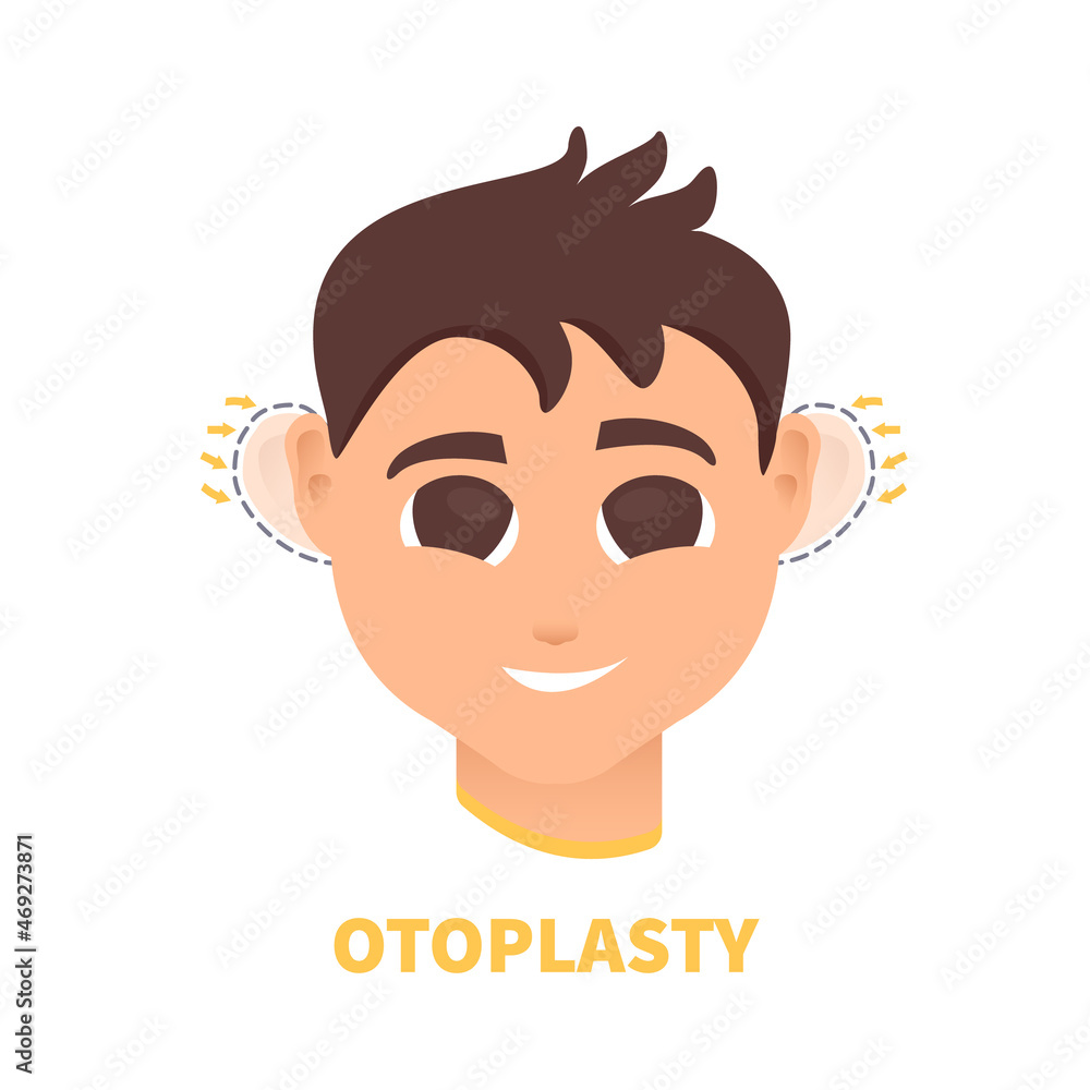 Cosmetic facial plastic ear surgery for men. Before and after otoplasty ...