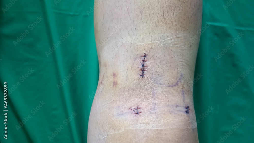 laparoscopic surgery, wound of patient after treatment with Minimally ...