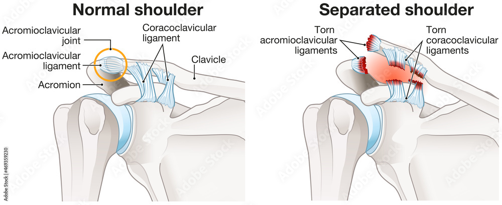 Acromioclavicular joint separation or AC joint separation or shoulder ...