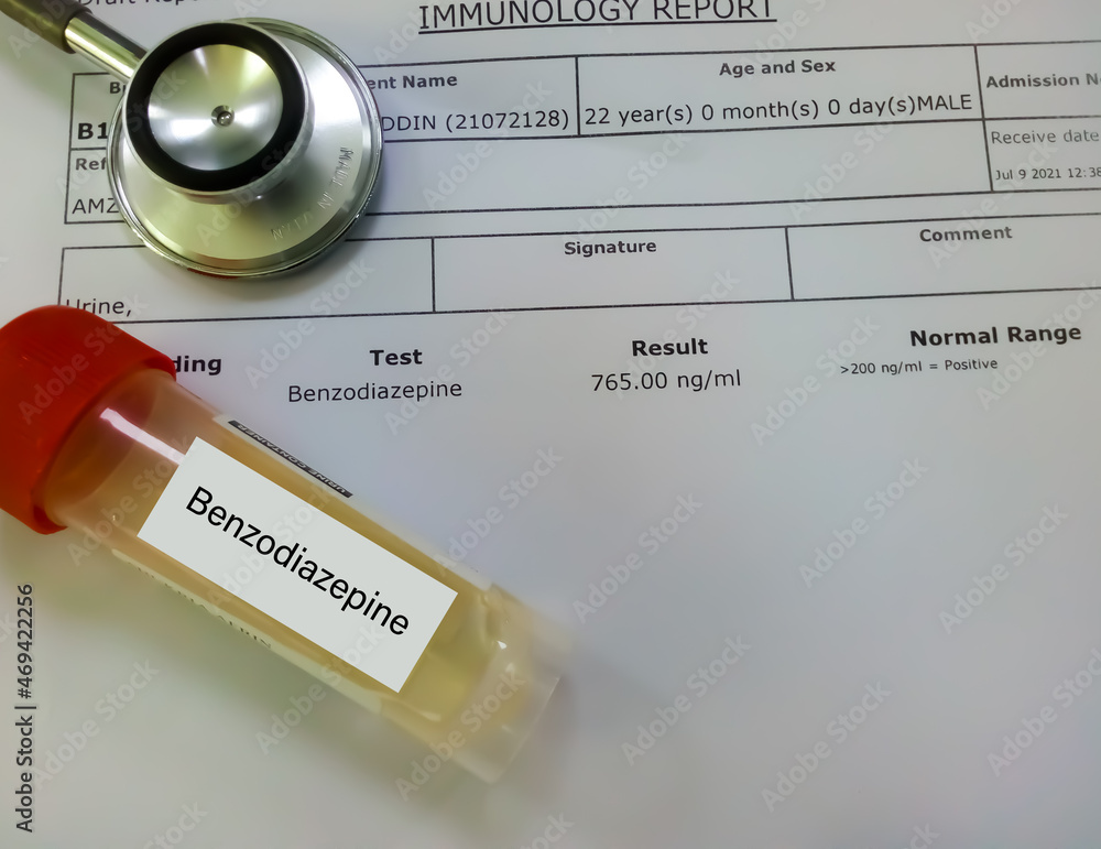 Urine sample and stethoscope isolated on positive Benzodiazepine ...