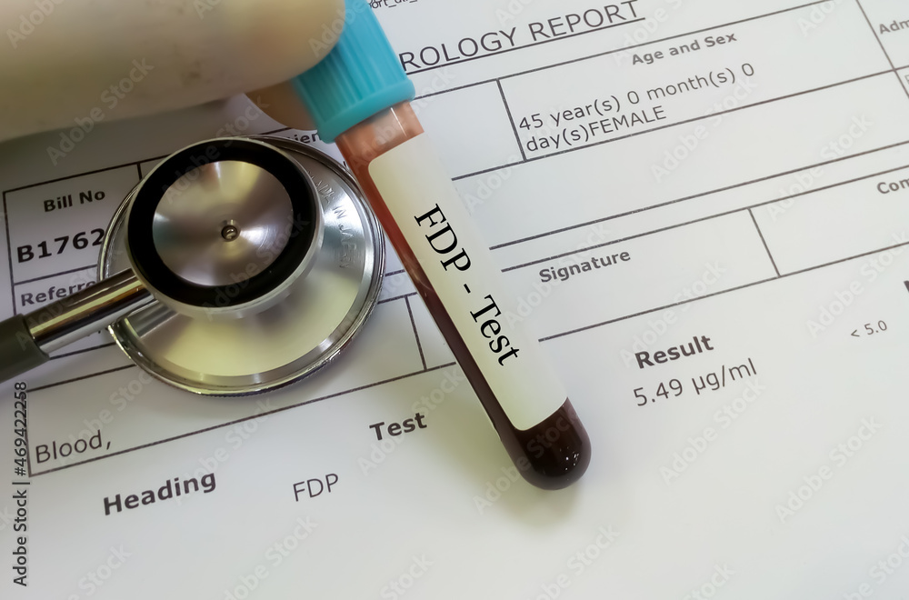 Technician hand blood tube and stethoscope isolated on FDP testing ...