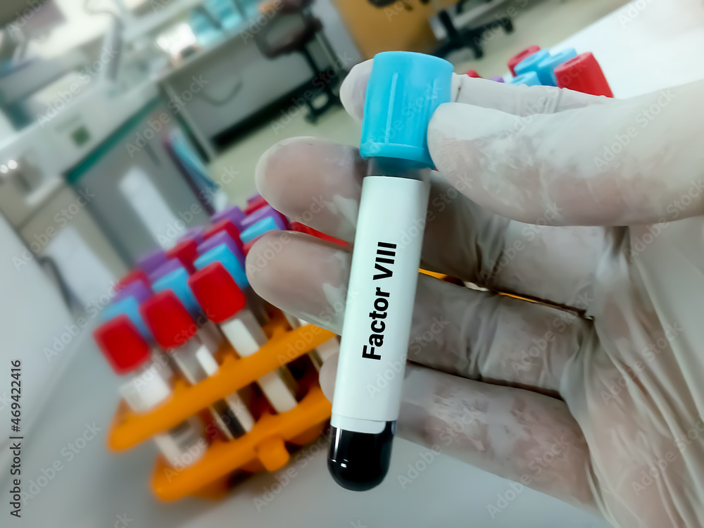 Blood Sample for Factor VIII. Blood coagulation testing. Medical or ...