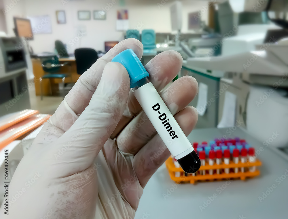 D Dimer test. Doctor or scientist hold a blood sample for test. close ...
