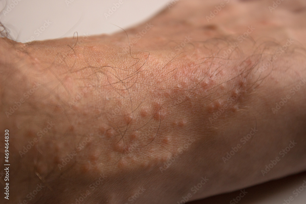 Allergic reaction on the leg. Rash on the foot. Dermatological disease ...