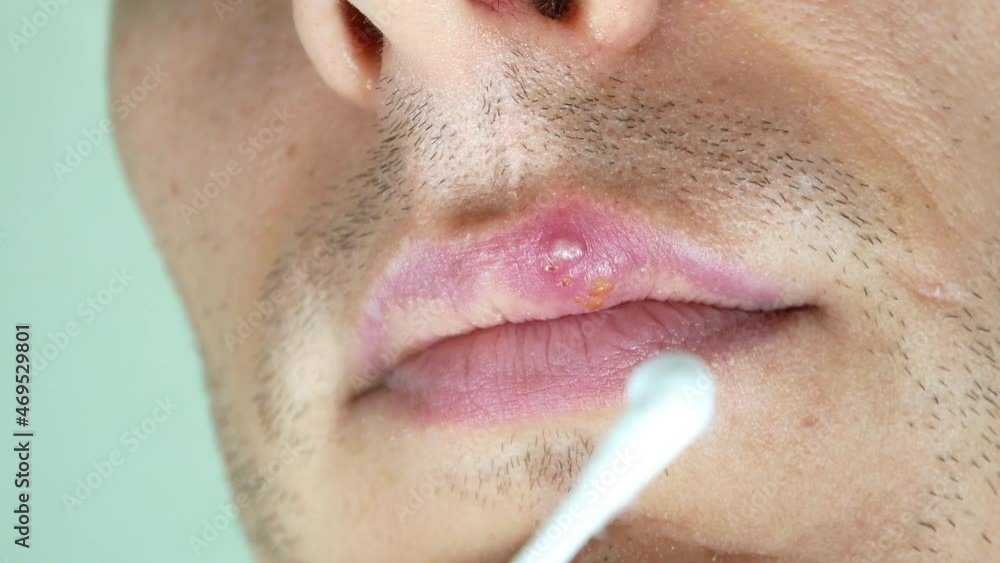Herpes labialis on the lip of a Caucasian man. Face close-up. Сold ...