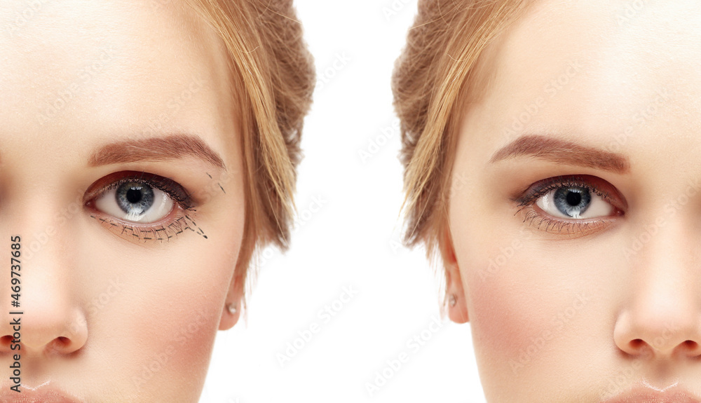 Lower Blepharoplasty.Marking the face.Perforation lines on females face ...
