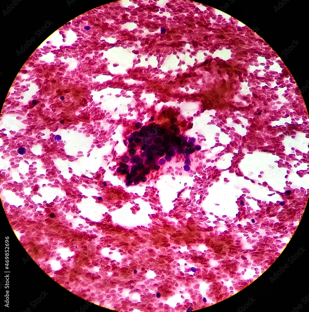 Hepatocellular Carcinoma Microscopic image of FNAC Fine Needle ...