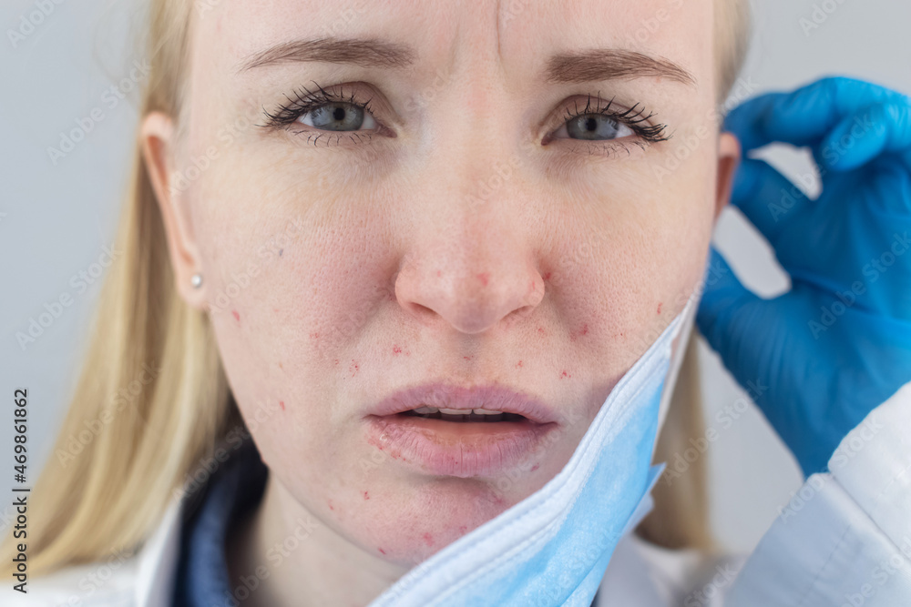 Doctor removes the protective mask and shows irritation on face skin ...