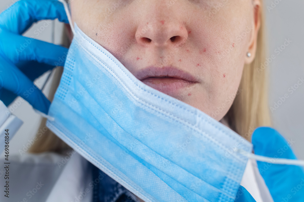 Doctor removes the protective mask and shows irritation on face skin ...