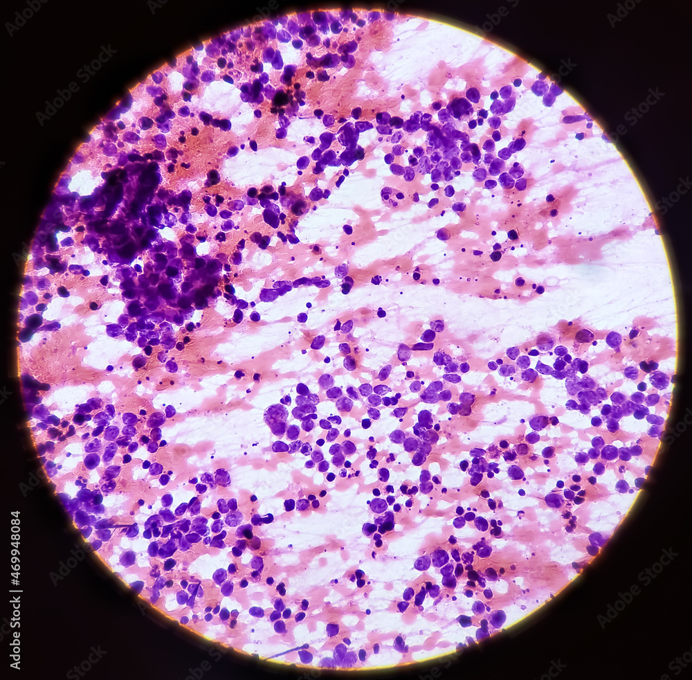Kidney cancer: Specimen collected by CT guided FNA from renal mass ...