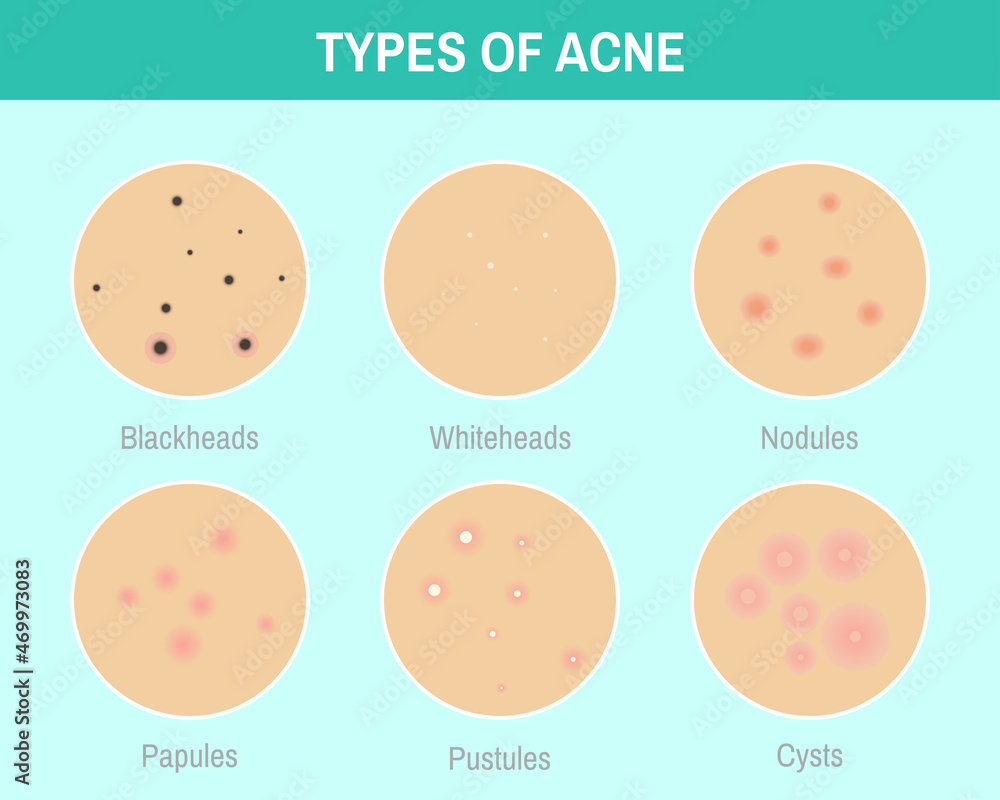 Types of acne. 6 circle images set of skin conditions. Colorful ...
