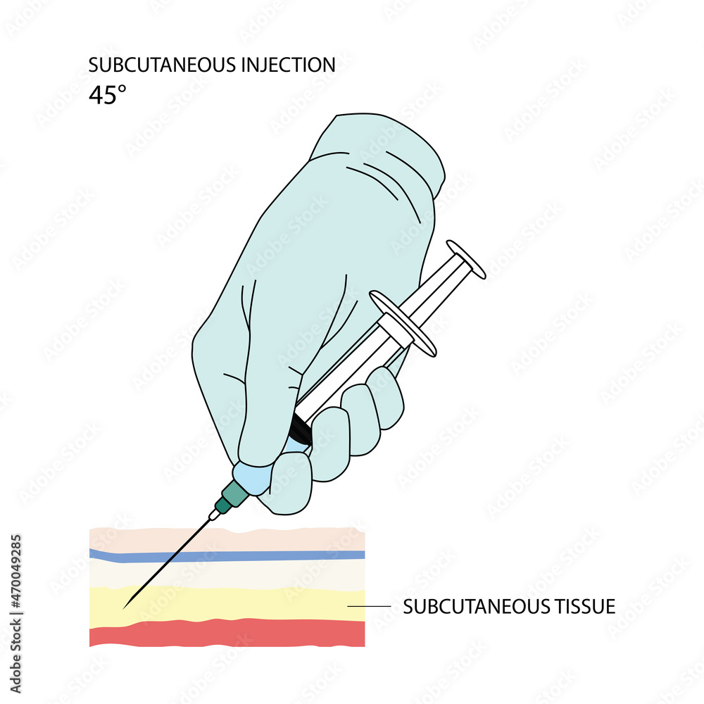 Subcutaneous injection. Effective methods of administration of drugs ...