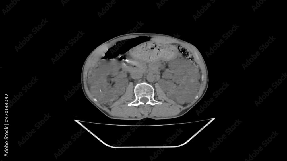 axial plane abdomen ct scan of Autosomal dominant polycystic kidney ...