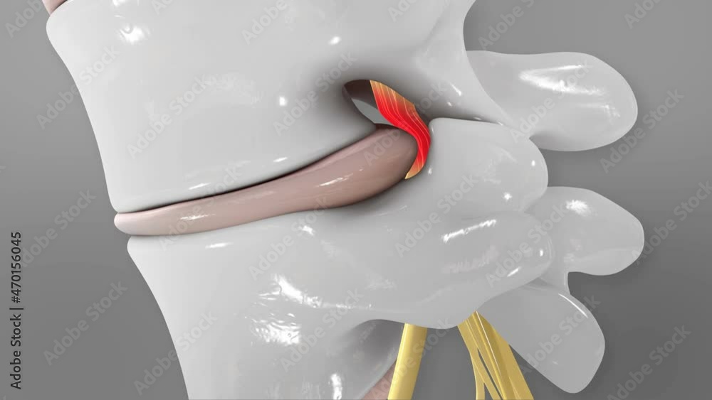 Vidéo Stock Herniated Disc Flexion 3D animation | Adobe Stock