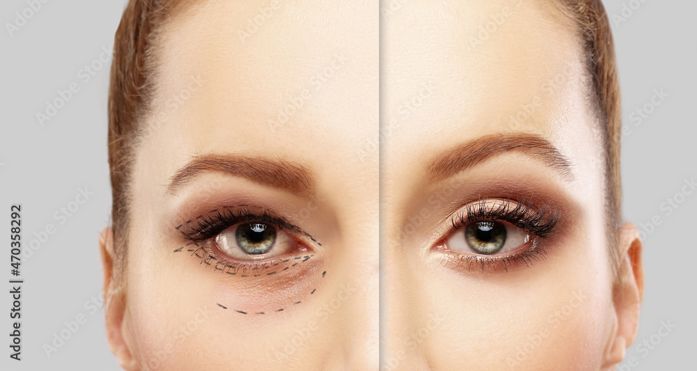 Lower and upper Blepharoplasty.Marking the face.Perforation lines on ...