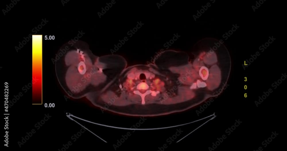 PET CT Scan of whole body from head to toe with fusion technique mix CT ...