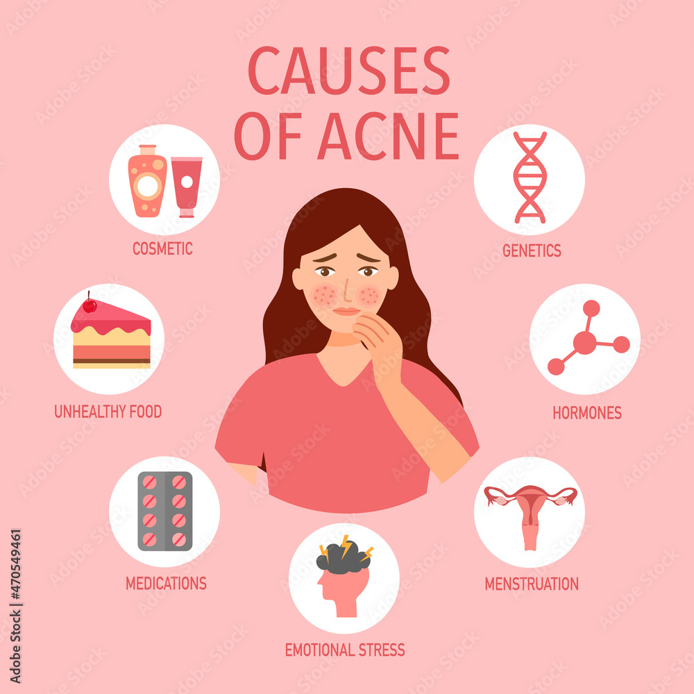 Causes of acne infographic in flat design. Source of pimple skin ...
