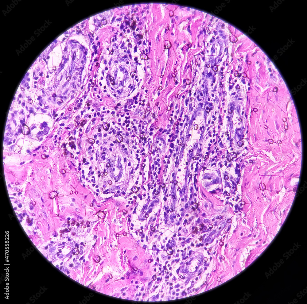 Pilonidal disease, pilonidal sinus tract, microphotograph of Compatible ...