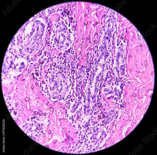 Pilonidal disease, pilonidal sinus tract, microphotograph of Compatible ...