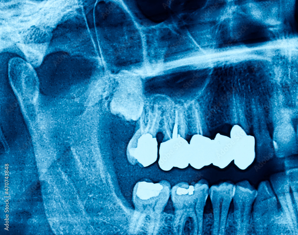 Radiograph dental X-Ray of a Caucasian male with wisdom tooth. Concept ...