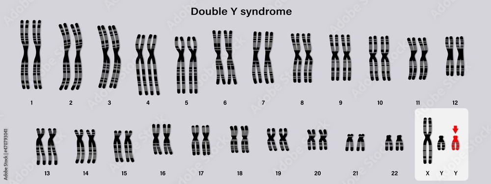 Human karyotype of Double y syndrome. XYY. Male has an extra Y ...