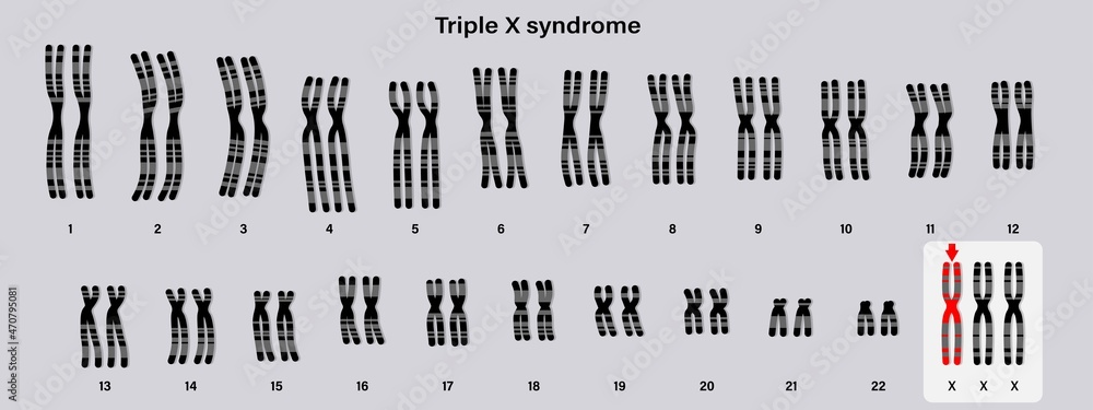 Human Karyotype Of Triple X Syndrome XXX Female Has An Extra X human-karyotype-of-triple-x-syndrome-xxx-female-has-an-extra-x