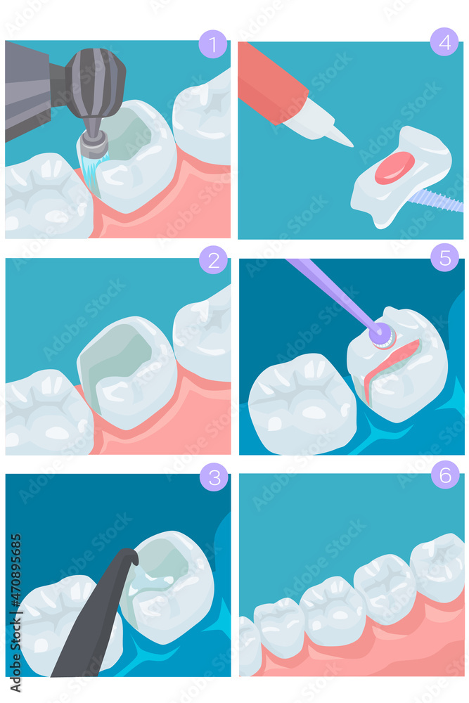 Dental treatment. Installing a tab, step by step instructions. Dental ...