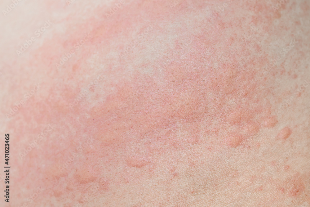 Allergic skin rash prickly heat skin red dot closeup skin problem ...