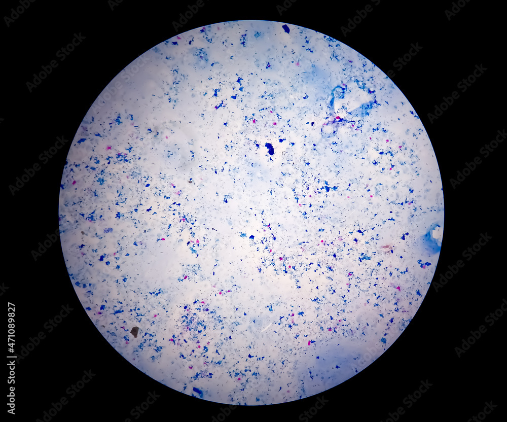Sputum smear AFB stain microscopic close view. Macrobacterium ...
