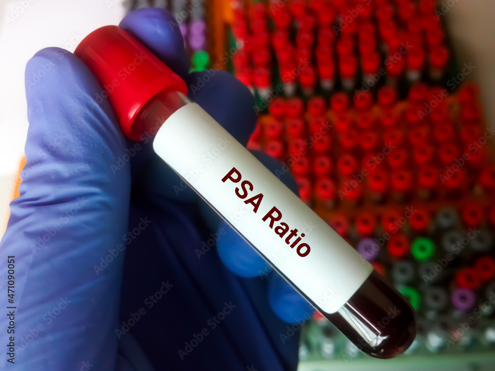 Biochemist hold test tube with blood sample for PSA Ratio test ...