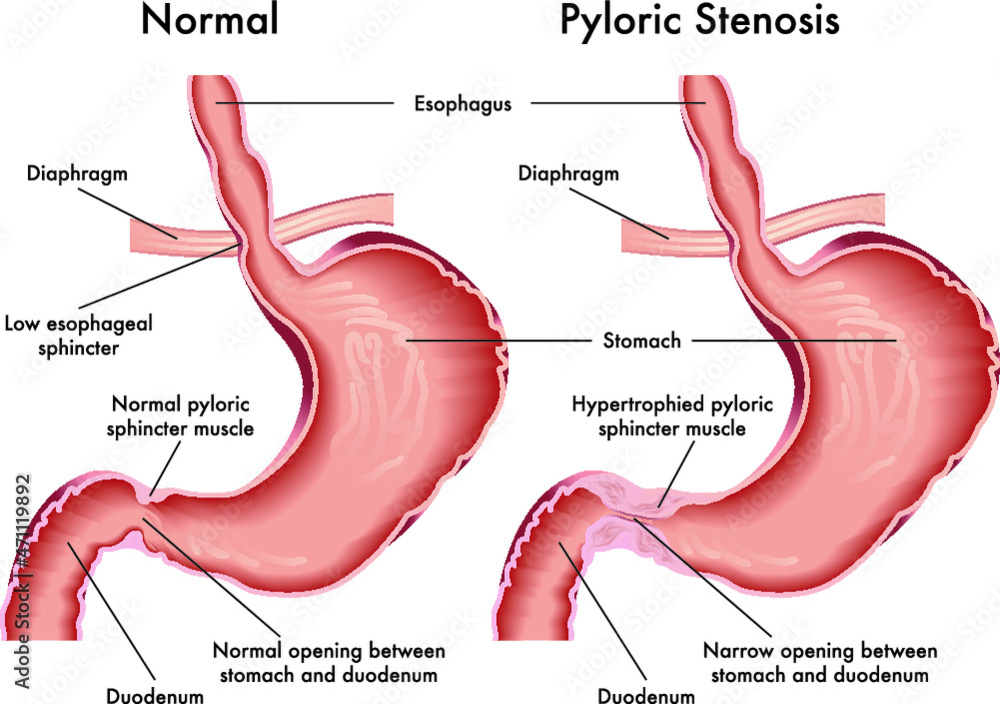 Medical illustration of symptoms of pyloric stenosis Stock ベクター | Adobe ...