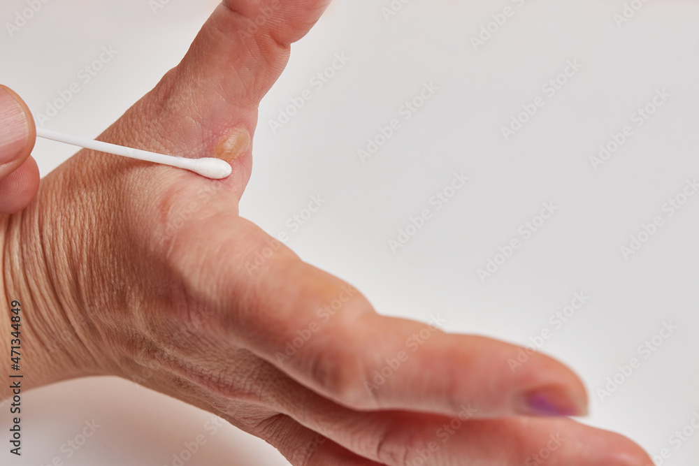 Blister on the hand after a household skin burn. First aid for skin ...